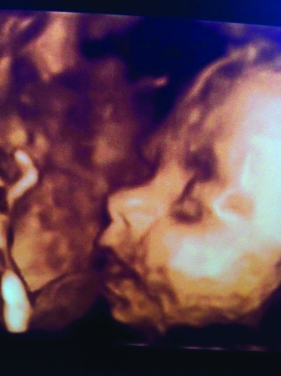 Ultrassom: as primeiras fotos do bebê | Mamãe Prática